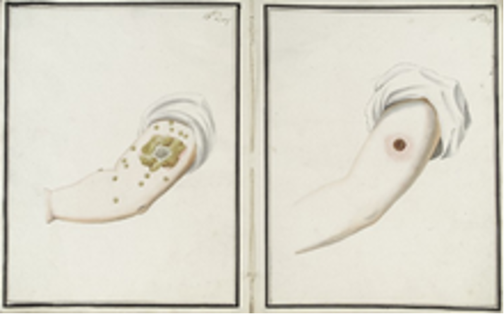 Edward Jenner, Cowpox Inoculation, and the History of Vaccines - ICJS ...